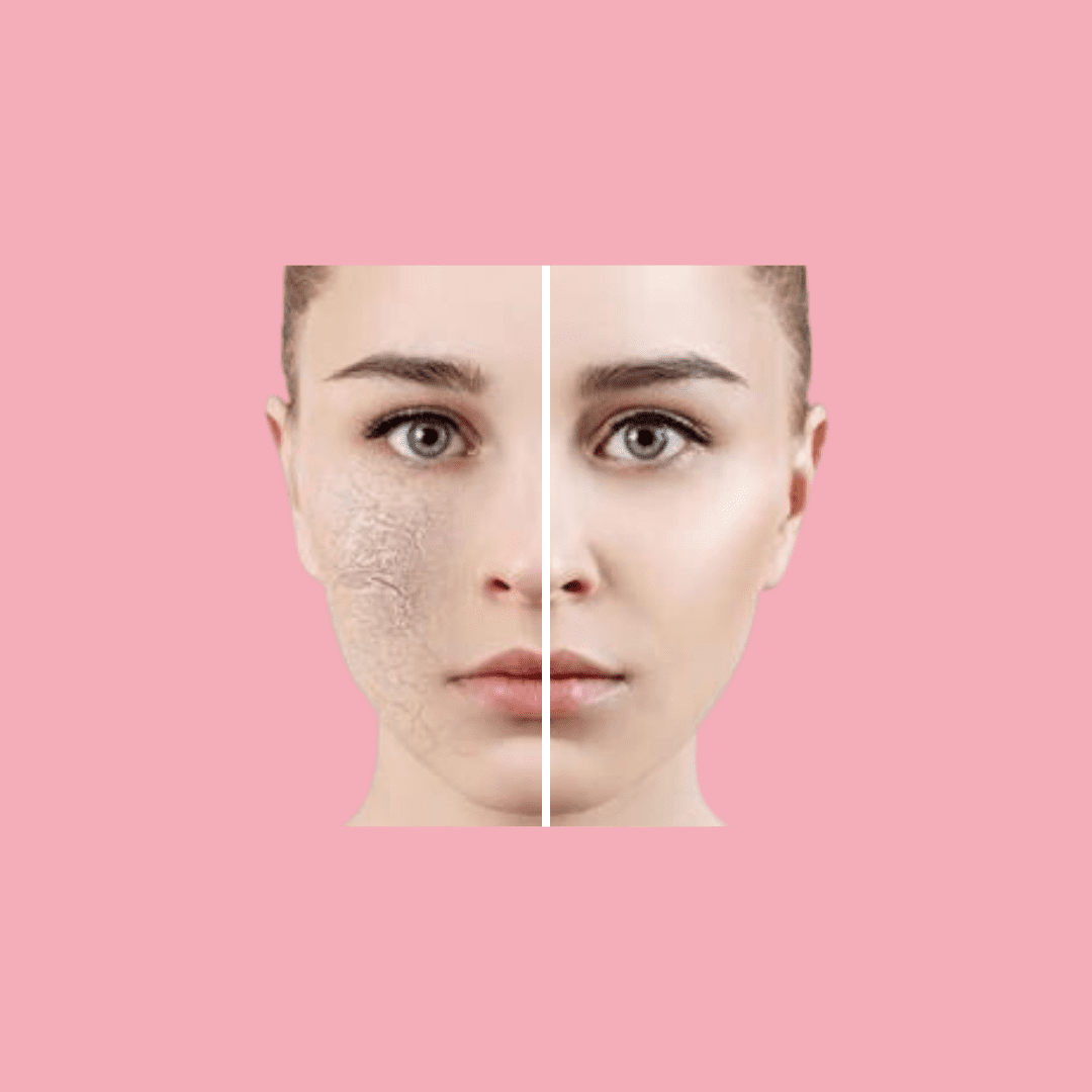CZ Hydration Facial – Pulse Laser at The Chookpen Spa CZ Hydration Facial – Pulse Laser at The Chookpen Spa